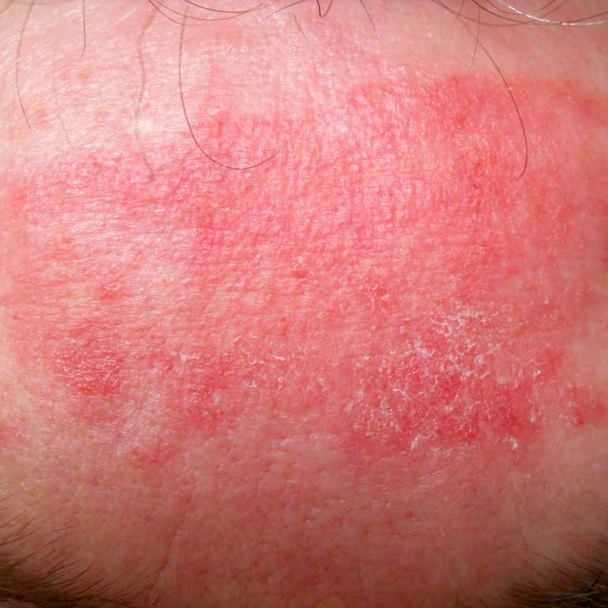 Study Shows How Eczema is Genetic | Cosmetics & Toiletries