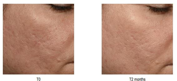 Sederma's BB-Biont Protects Holobiont, Reducing Pockmarks | Cosmetics ...