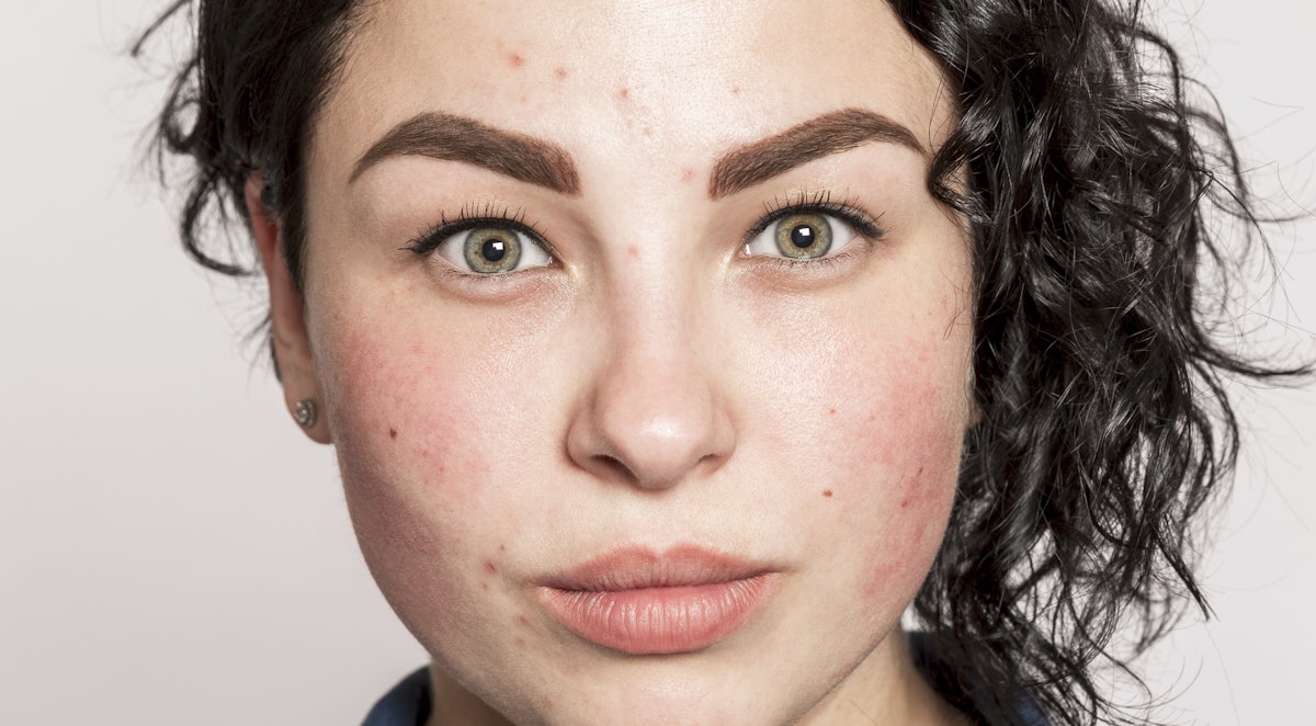 Cutera Releases Acne Survey Results and AviClear Device | Cosmetics ...