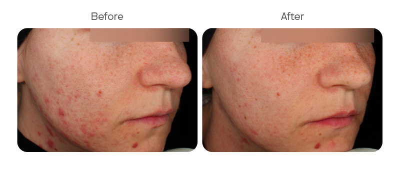 What if The Rules of Fighting Acne Have Changed? | Cosmetics & Toiletries